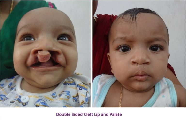 Cleft Lip Surgery India Promotion – Richardson's Plastic Surgery Hospitals