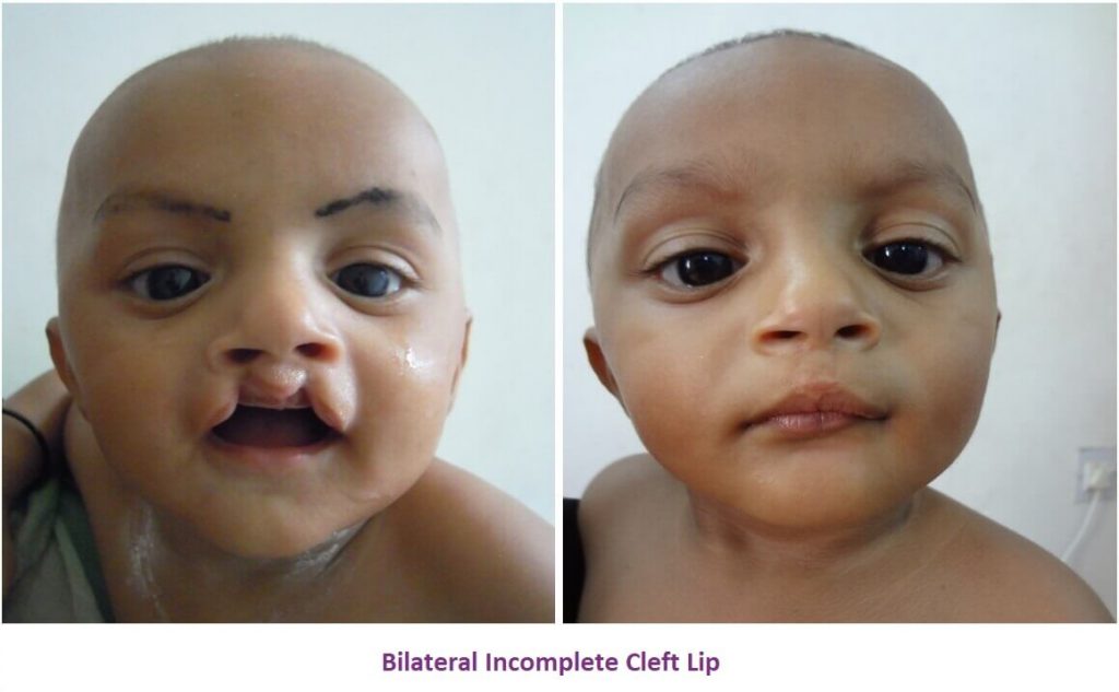 Cleft Lip Surgery India Promotion – Richardson's Plastic Surgery Hospitals