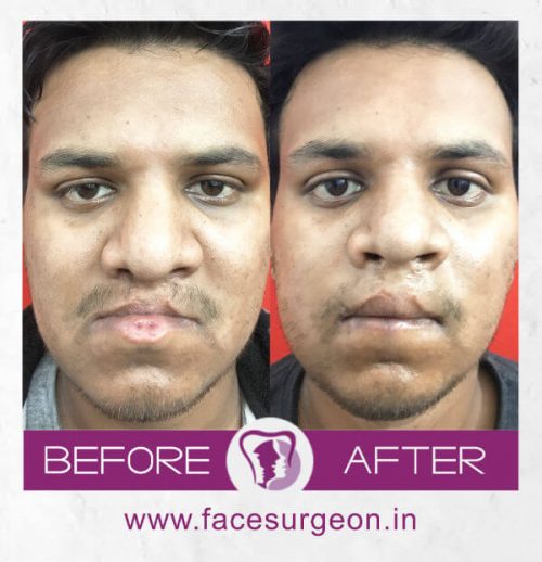 Maxillary Osteotomy- Everything About Upper Jaw Surgery – Richardson's ...