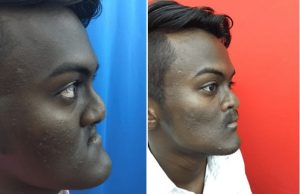 4 Things You Must Know About Retrognathia Surgery In India – Richardson ...