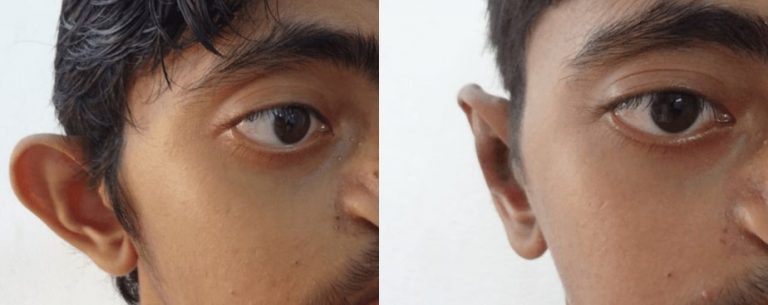 Plastic Ear Surgery In India: Results, Recovery And Cost – Richardson's ...