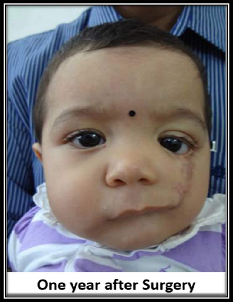 Cleft Lip and Cleft Palate Treatment in India | Cleft Cosmetic Surgery