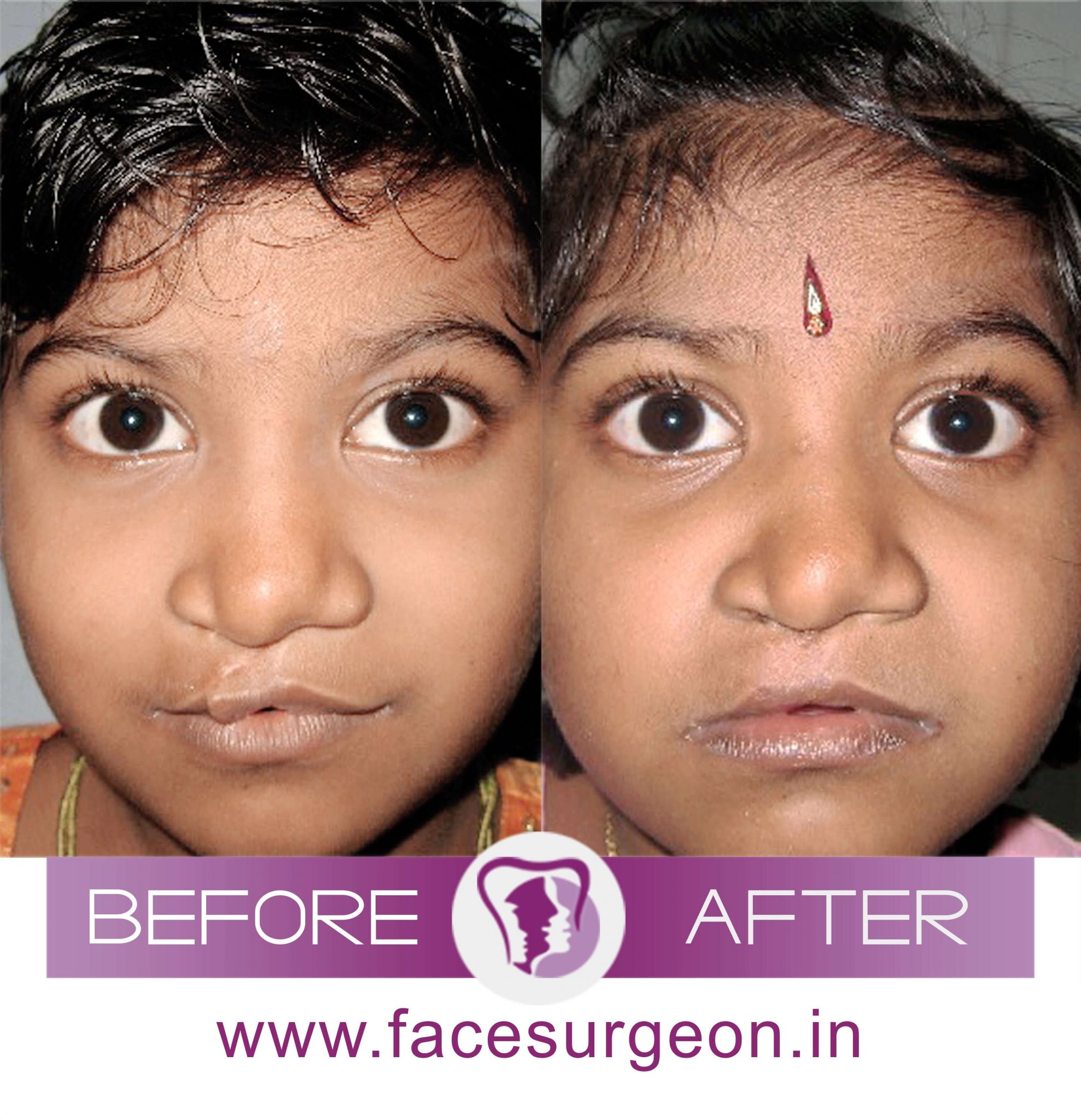 3 Things You Must Know About Cleft Lip Revision Surgery In India ...