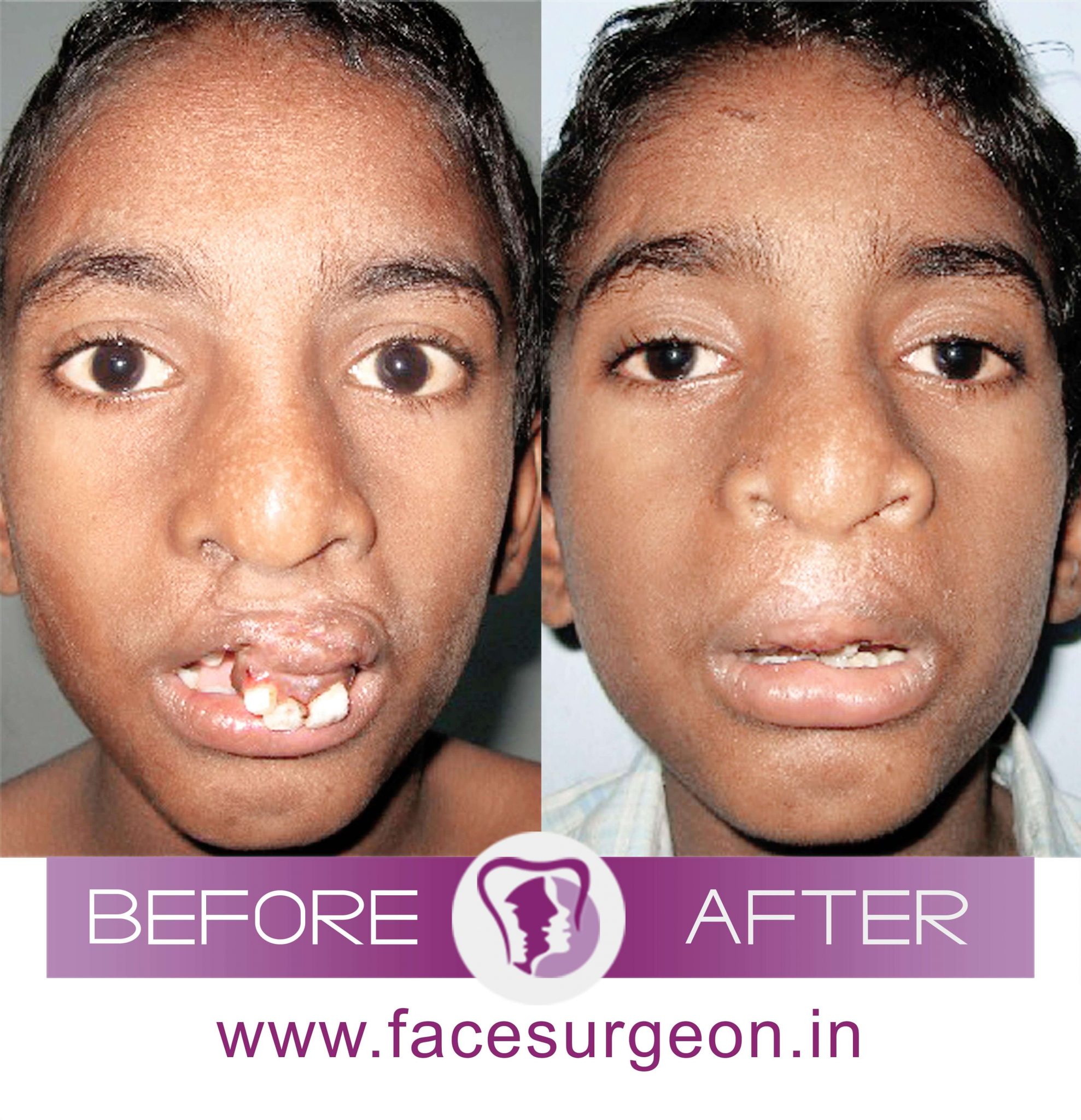 All That You Wanted to Learn About Cleft Palate Revision Surgery in ...