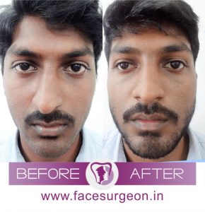 All That You Wanted to Know About Nose Surgery or Nose Job in India ...