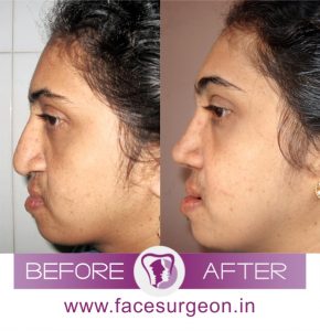 All That You Wanted To Know About Broad Nose Correction – Richardson's ...