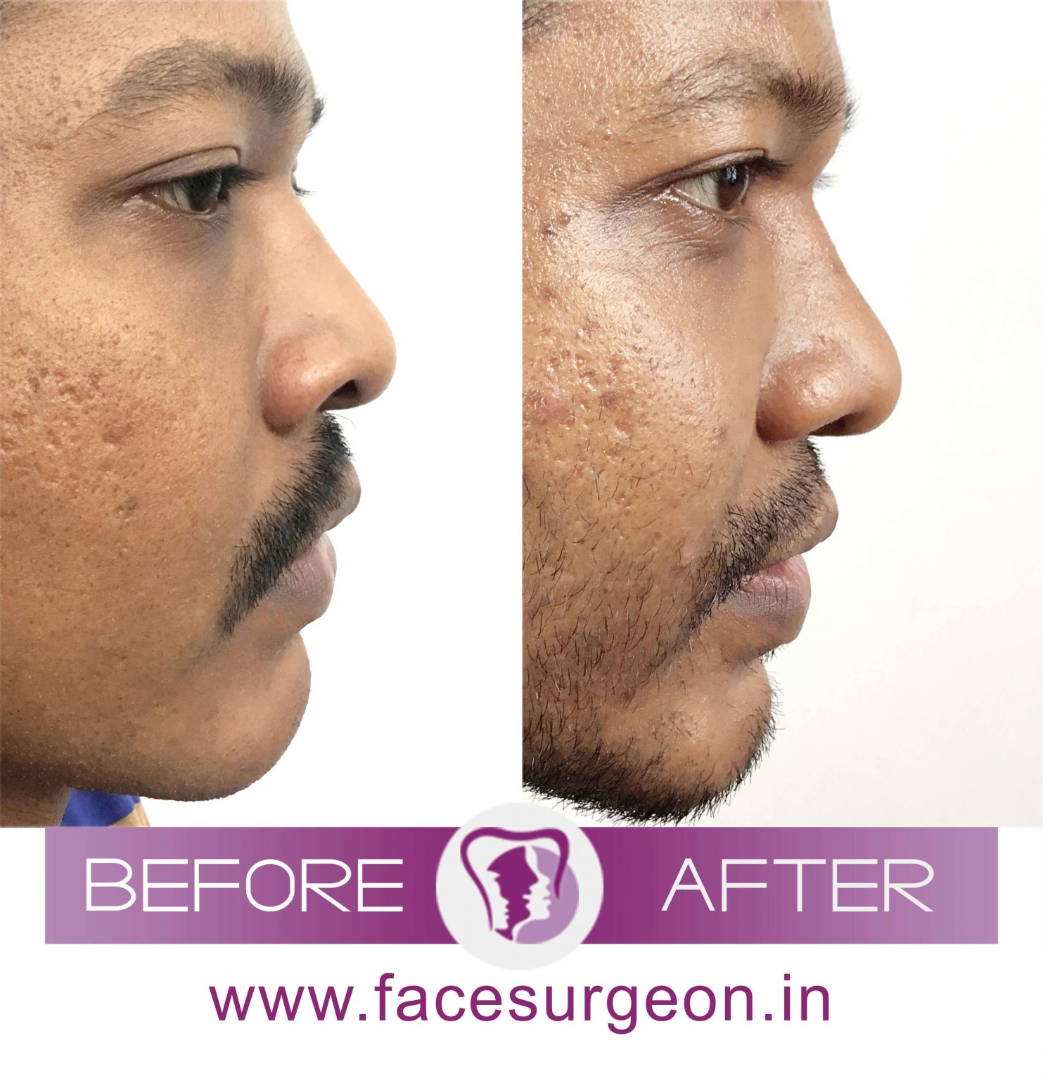 Essential Corrective Surgery For Lower Jaw Protrusion In India ...