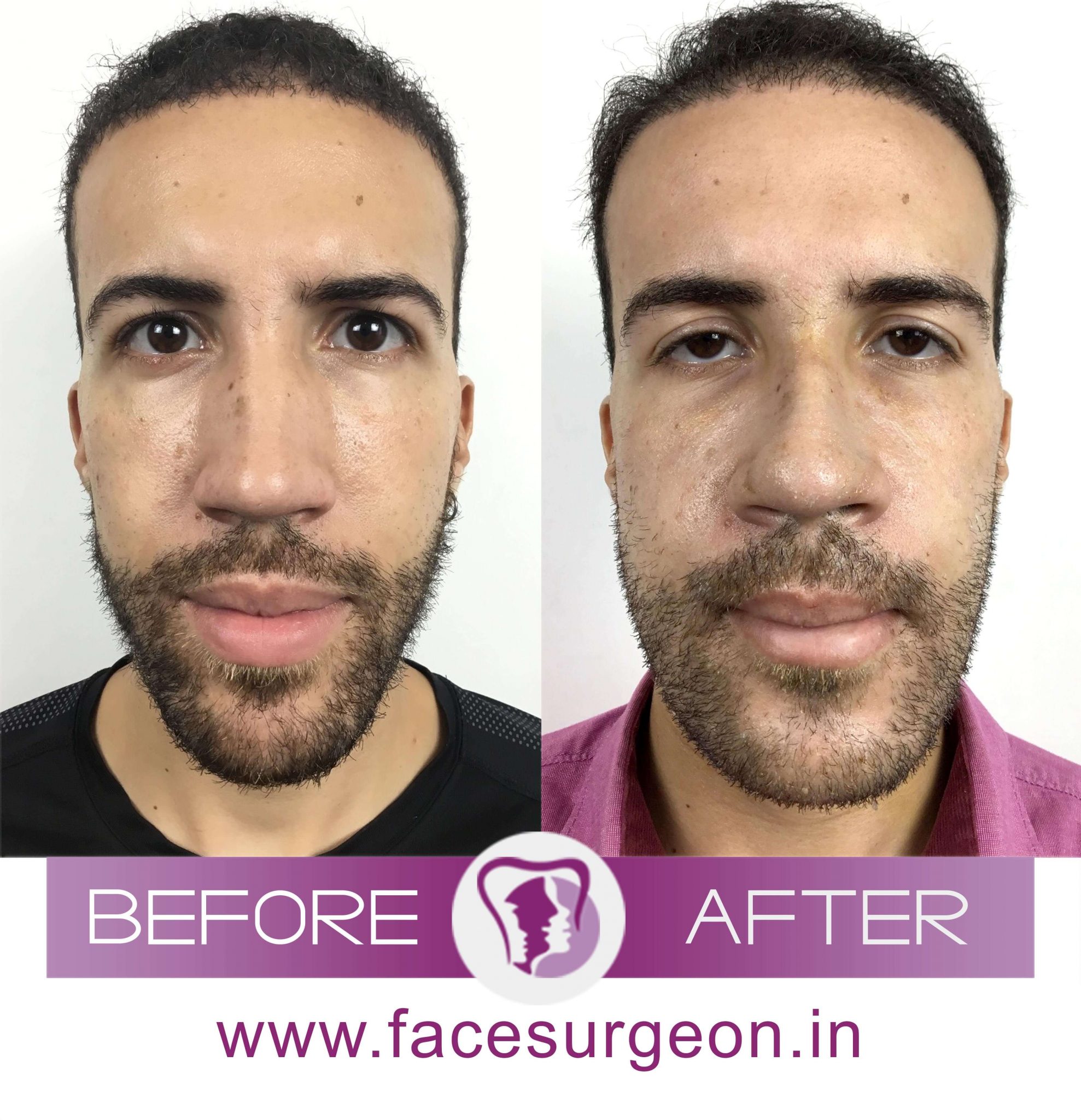 Nose Bridge Surgery for A Depressed Nasal Bridge – Richardson's Plastic ...