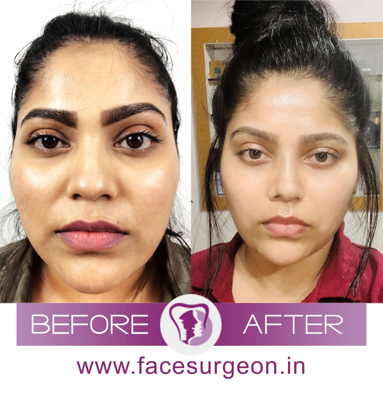 Nose Bridge Surgery for A Depressed Nasal Bridge – Richardson's Plastic ...