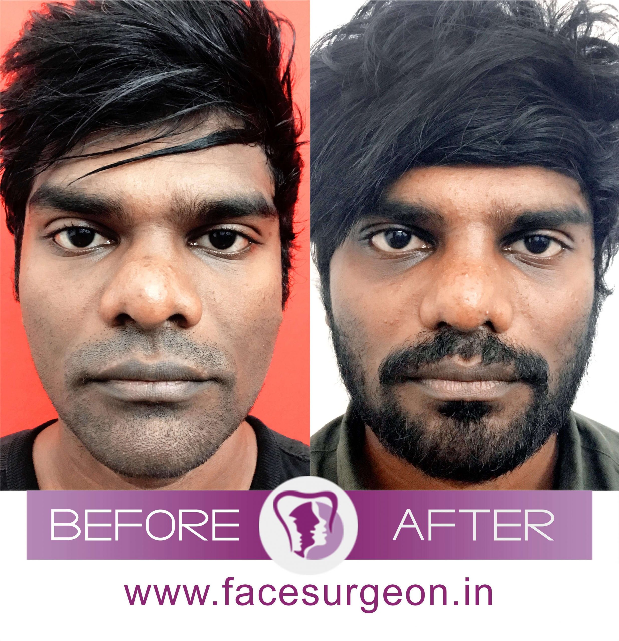 How To Reduce Size Of Nose Flatdisk24 How To Reduce Size Of Nose Flatdisk24