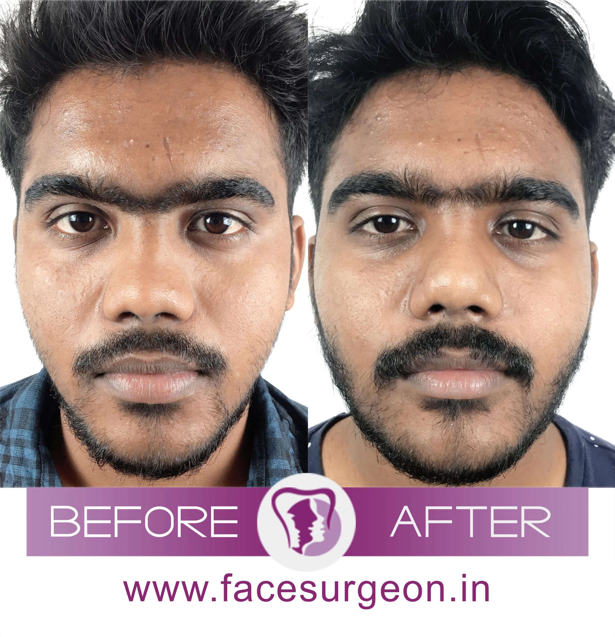 All That You Wanted To Know About Broad Nose Correction Surgery ...