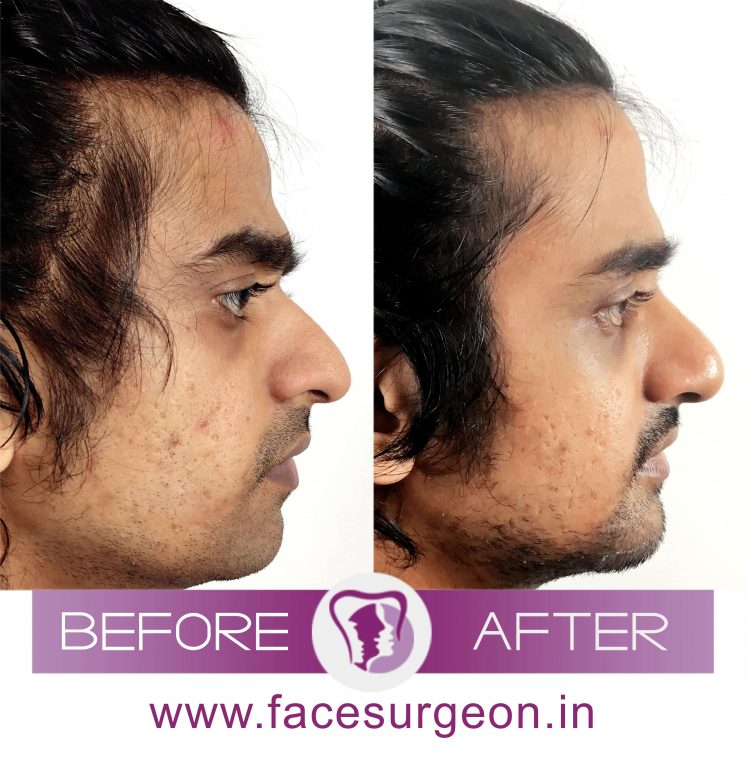 All That You Wanted To Know About Broad Nose Correction Surgery ...