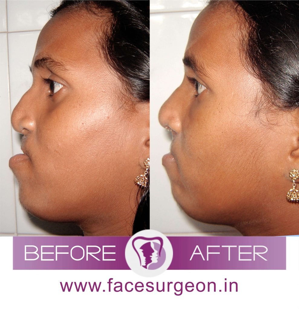Essential Corrective Surgery For Lower Jaw Protrusion In India ...