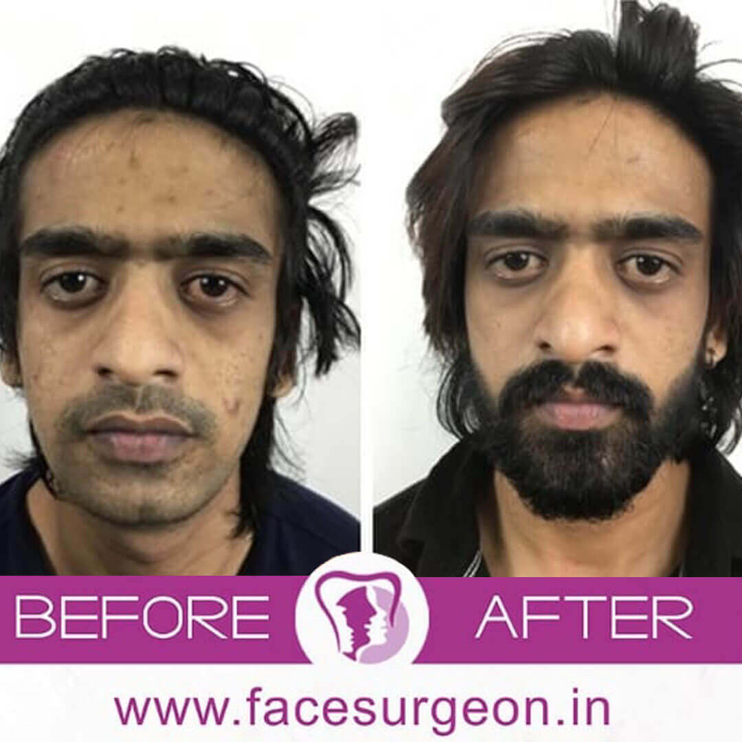 All That You Need To Know About Beard Hair Transplant In India ...