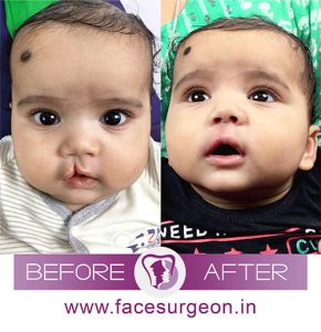 Cleft Lip And Palate Surgery Photos | Richardsons Hospital