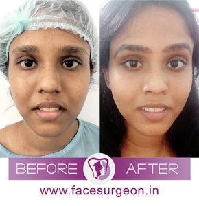 Face Makeover Surgery Photos | Richardsons Hospital
