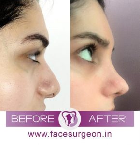 Nose Surgery Photos | Richardsons Hospital