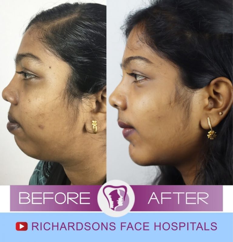 Nose Surgery Photos | Richardsons Hospital
