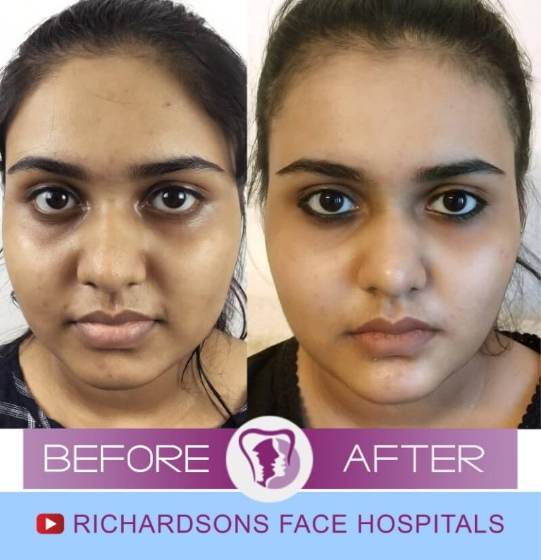 Nose Surgery Photos | Richardsons Hospital