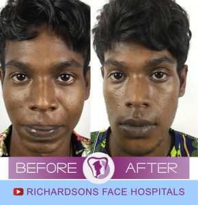 Facial Trauma Surgery Photos | Richardsons Hospital