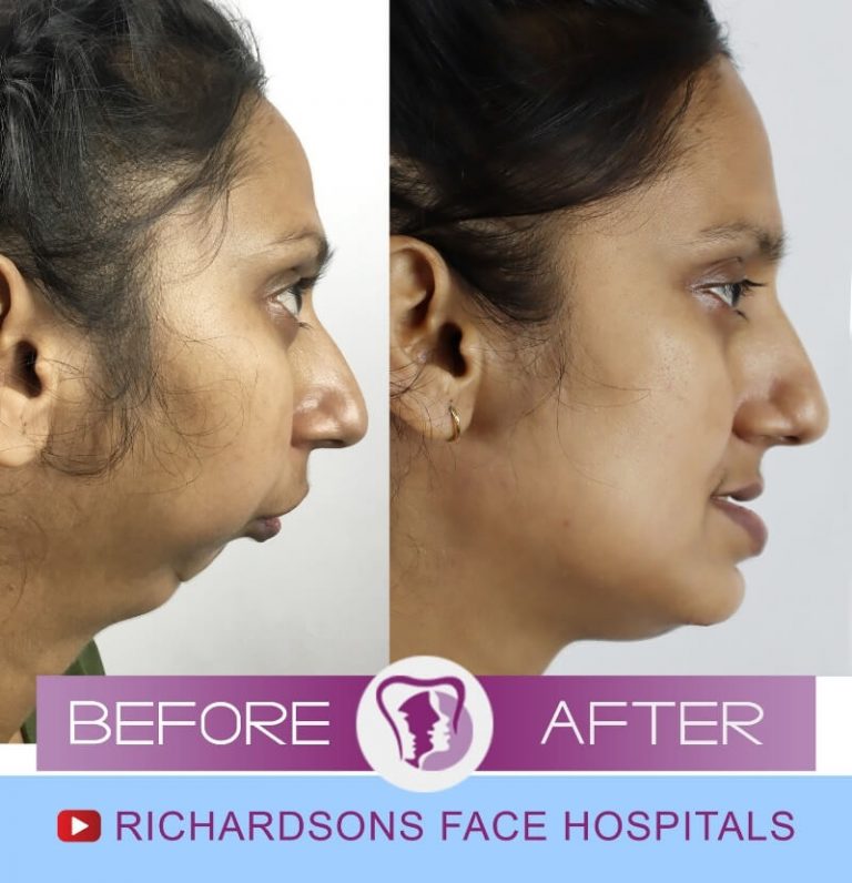 Facial Asymmetry Surgery Photos | Richardsons Hospital