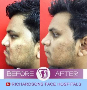 Anterior Maxillary Distraction - Richardson's Plastic Surgery Hospitals