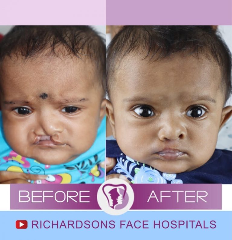 Cleft Lip And Palate Surgery Photos | Richardsons Hospital