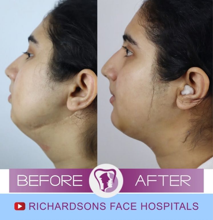 4 Things You Must Know About Maxillomandibular Advancement Surgery in ...