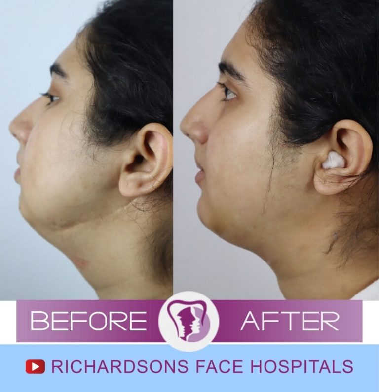 4 Things You Must Know About Maxillomandibular Advancement Surgery in ...