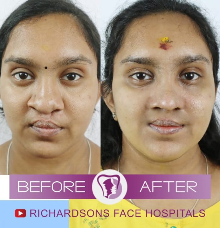 Cleft Lip And Palate Surgery Photos | Richardsons Hospital