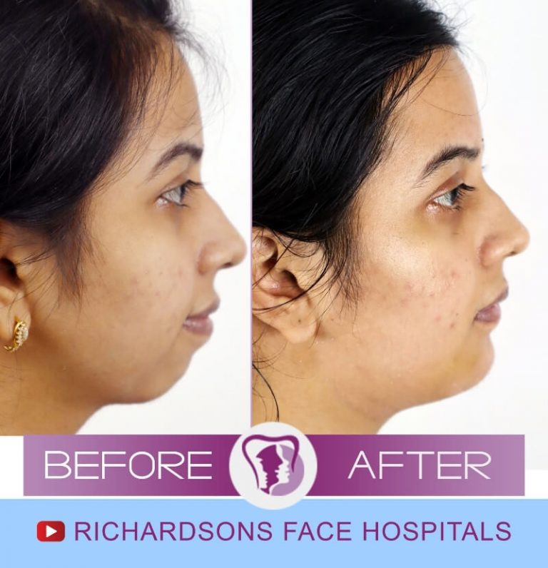 Nose Surgery Photos | Richardsons Hospital