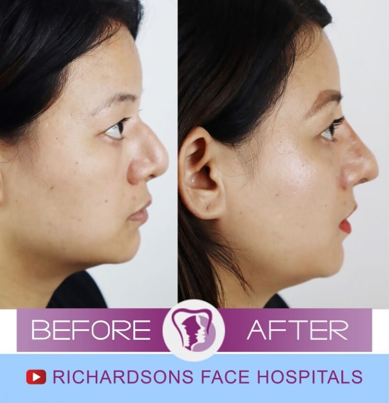 4 Things You Must Know About Post Traumatic Rhinoplasty In India ...
