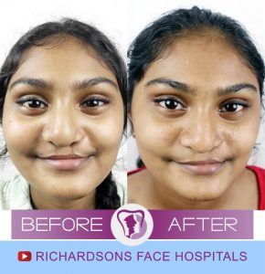 Anterior Maxillary Distraction - Richardson's Plastic Surgery Hospitals