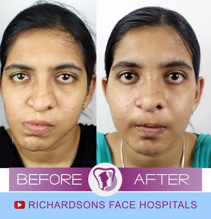 Anterior Maxillary Distraction - Richardson's Plastic Surgery Hospitals