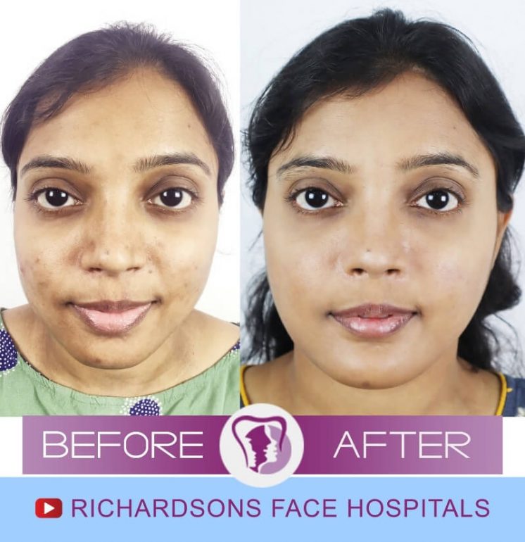 Can You Cure Snoring Using Genioplasty? – Richardson's Plastic Surgery ...