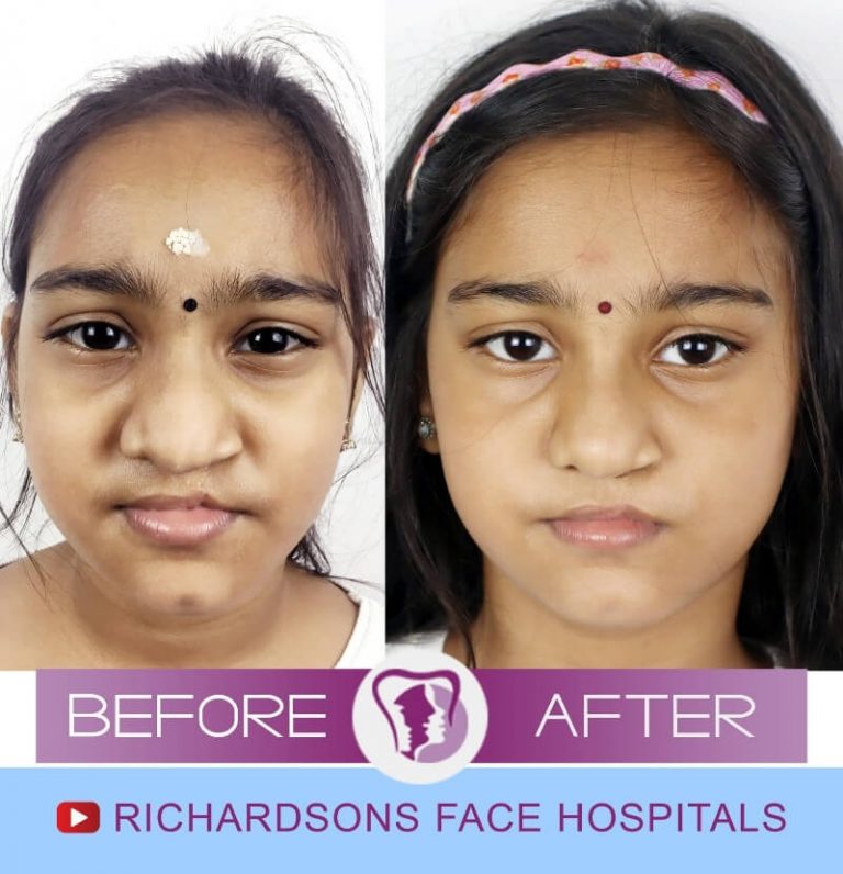 Cleft Lip And Palate Surgery Photos | Richardsons Hospital