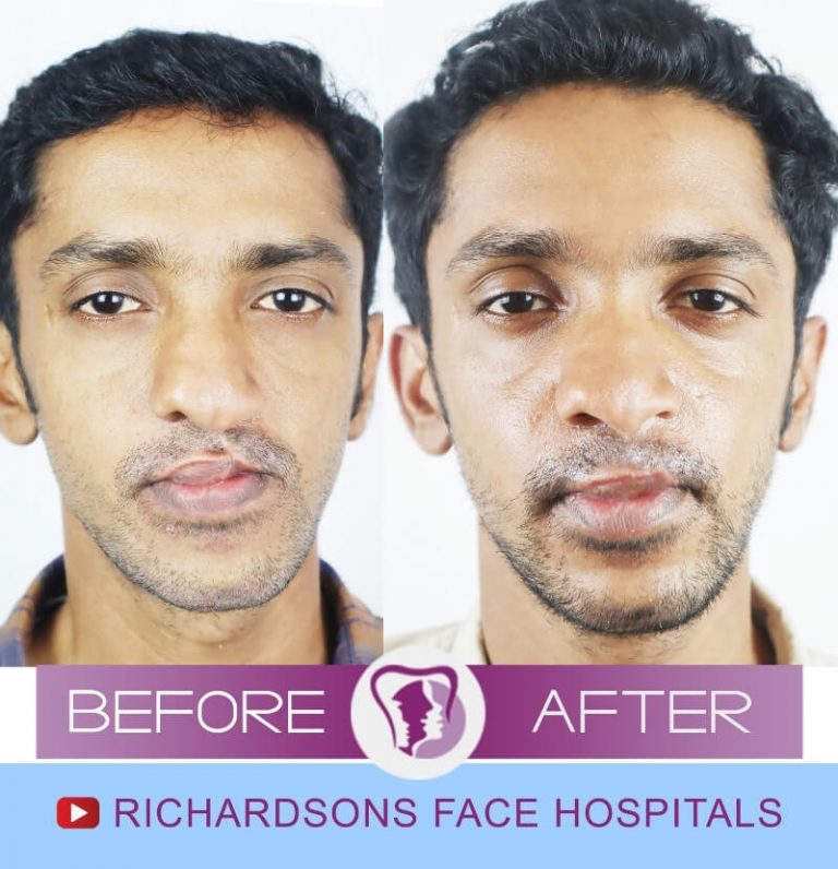 Anterior Maxillary Distraction Photos | Richardsons Hospital