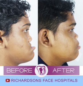 Anterior Maxillary Distraction Photos | Richardsons Hospital