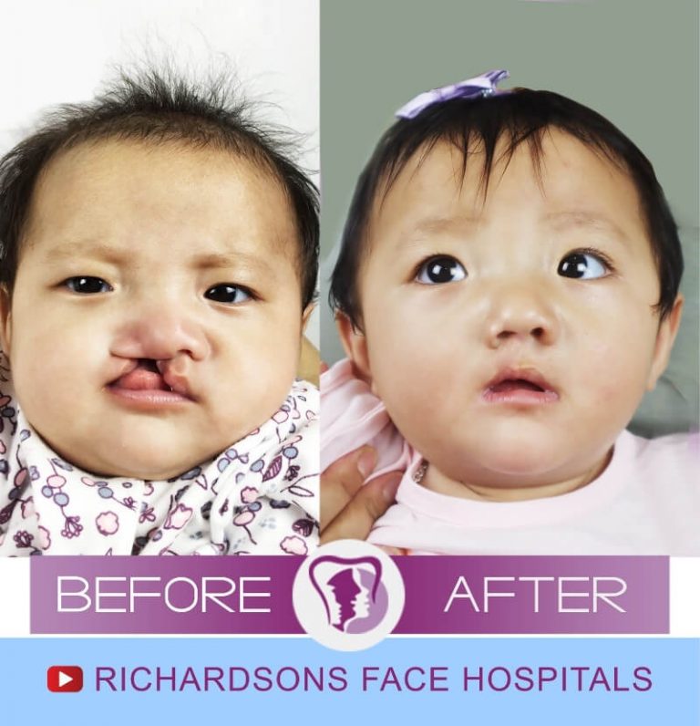 Cleft Lip And Palate Surgery Photos | Richardsons Hospital