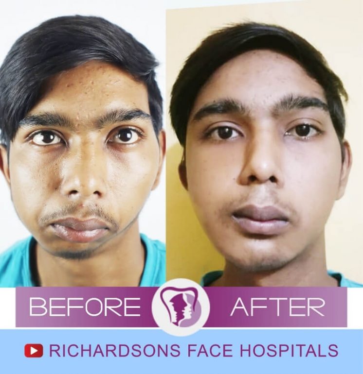 5 Things You Need to Know About Open Joint TMJ Surgery in India ...