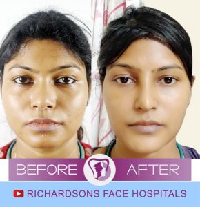 Genioplasty Photos | Richardsons Hospital