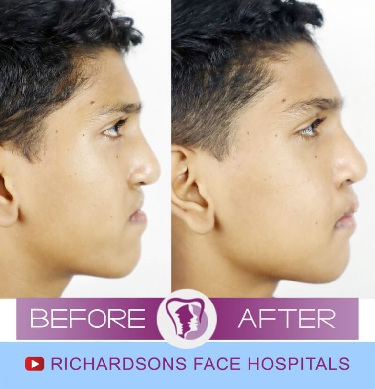 Anterior Maxillary Distraction Photos | Richardsons Hospital