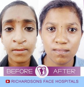 Cleft Lip And Palate Surgery Photos | Richardsons Hospital