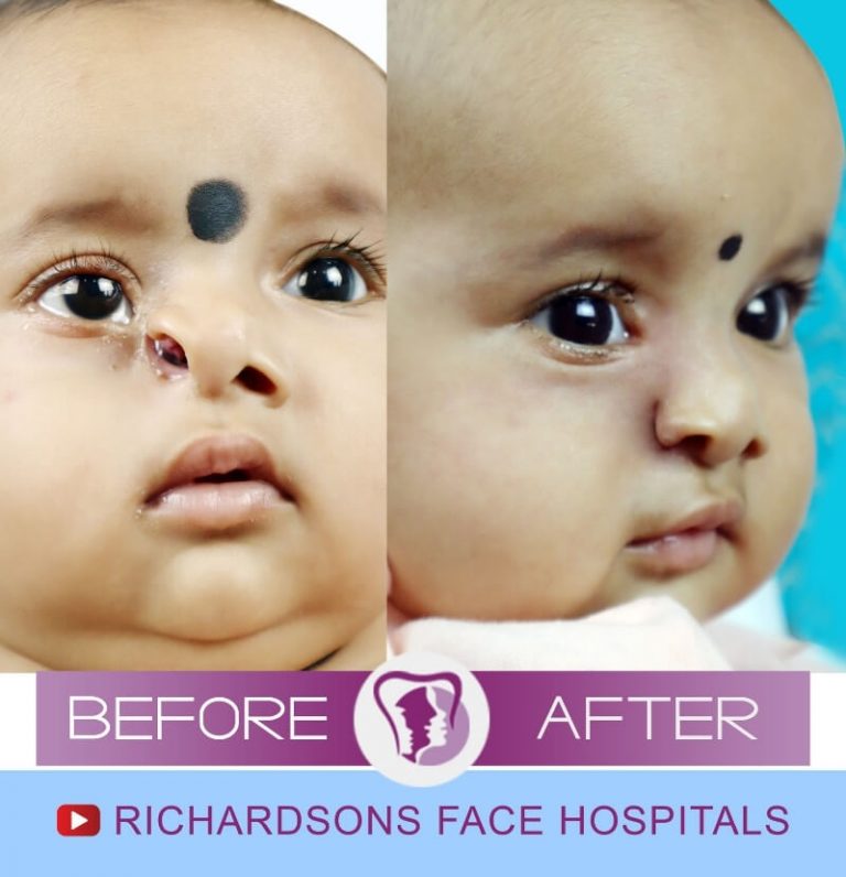 Cleft Lip And Palate Surgery Photos | Richardsons Hospital