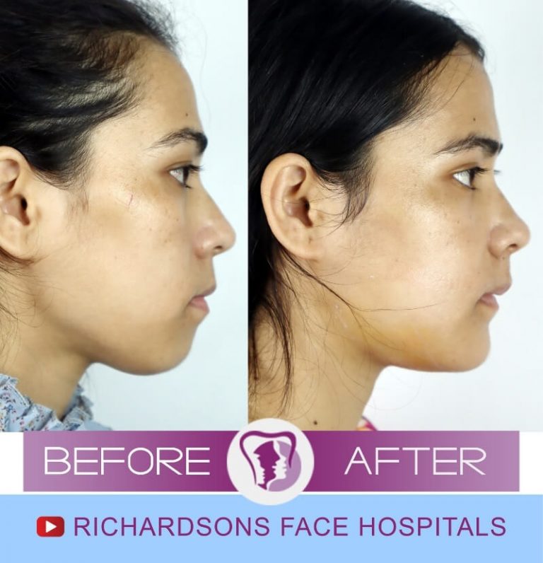 Genioplasty Photos | Richardsons Hospital