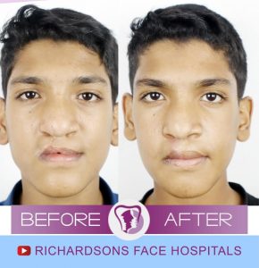 Anterior Maxillary Distraction Photos | Richardsons Hospital