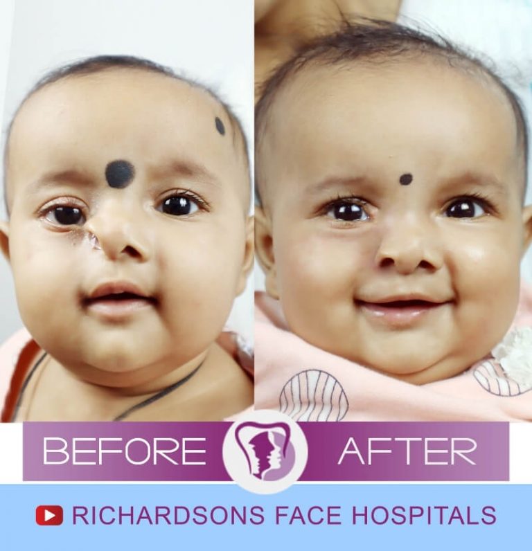 Cleft Lip And Palate Surgery Photos | Richardsons Hospital