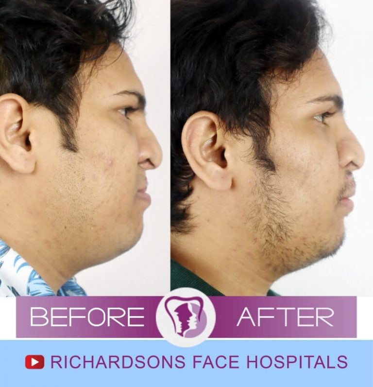 Anterior Maxillary Distraction Photos | Richardsons Hospital