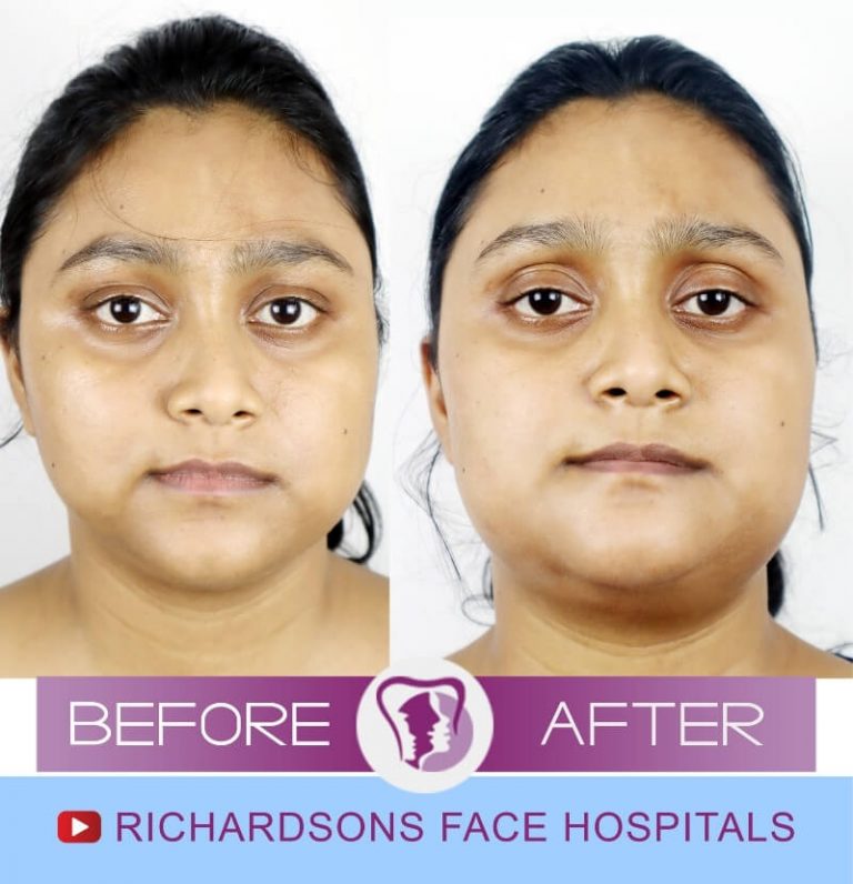 Facial Asymmetry Surgery - Richardson's Plastic Surgery Hospitals