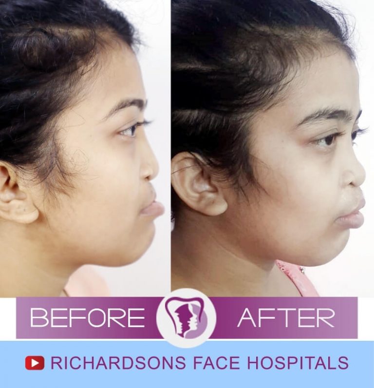 Anterior Maxillary Distraction Photos | Richardsons Hospital